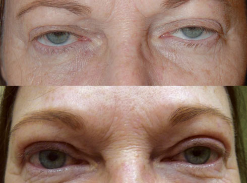 Eyelid Surgery and Excessive Tearing: An In-Depth Discussion - Desert ...